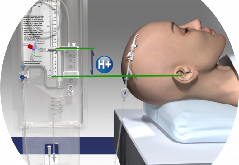 Derivação Ventricular Externa (DVE)
